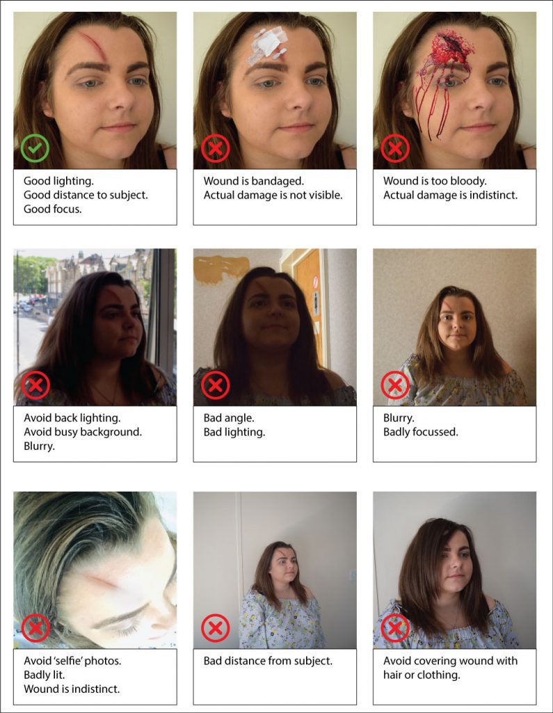 Taking Photographs of Your Scarring - Pictorial Guide